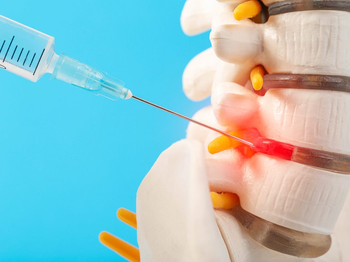 RFA Injections for Disc Herniation: Risks, Effectiveness, and a Safer ...